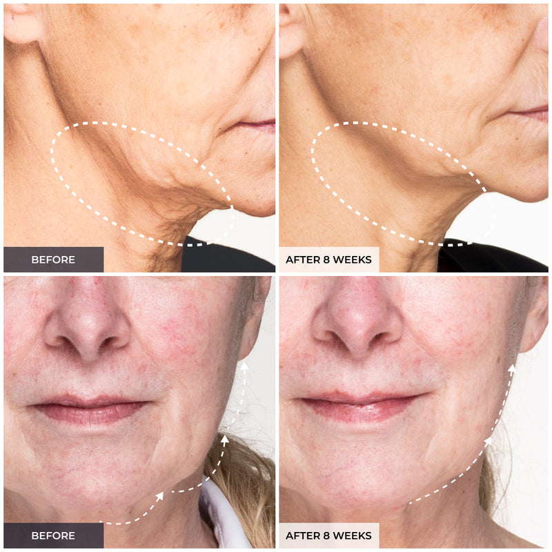 Medi Lift Essential Mask – EMS Facial Toning & Lifting Device