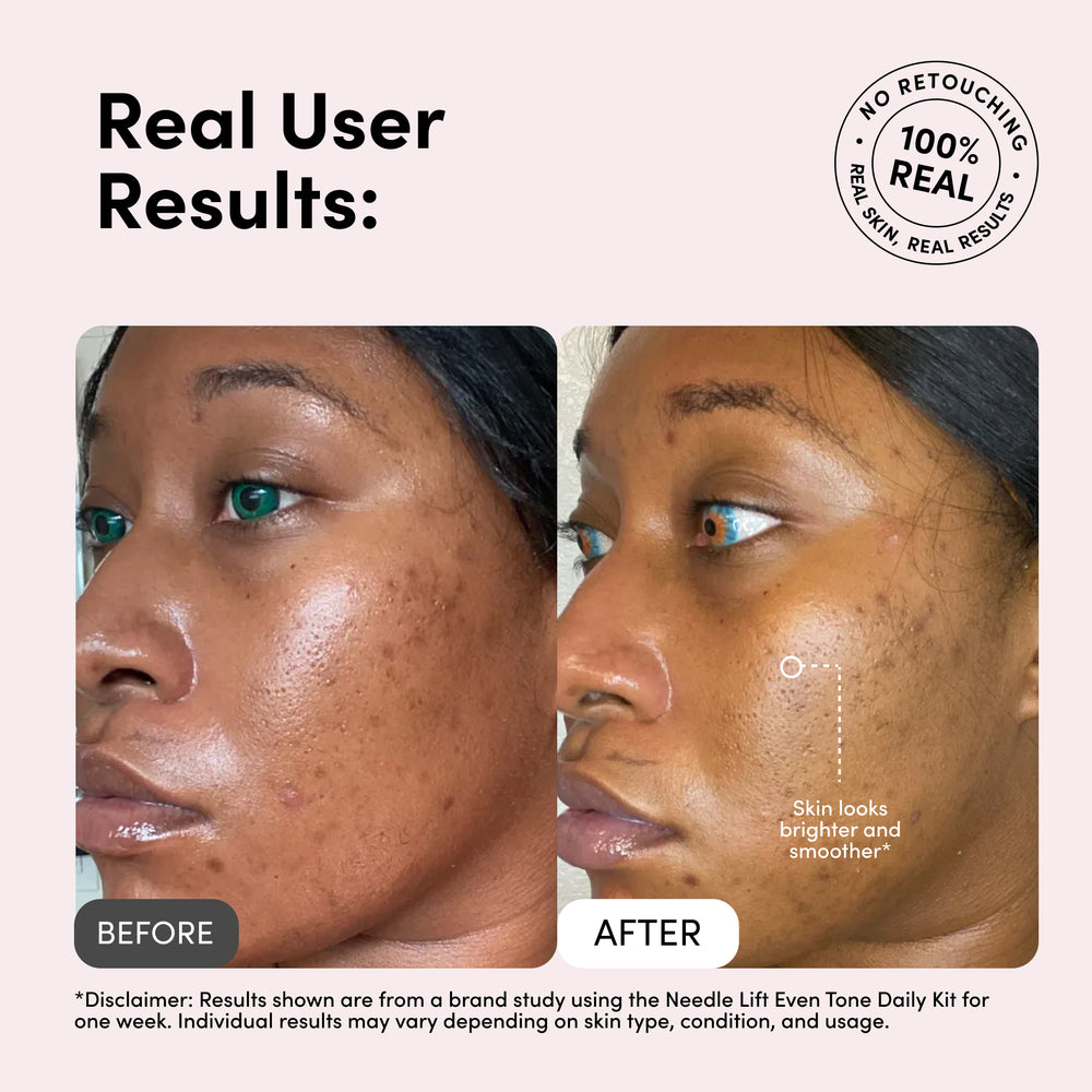 Medi Lift – Needle Lift Even Tone Daily Kit | Hydrate, Brighten, and ...